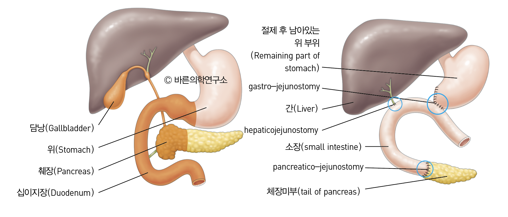 [보충] Whipple procedure vs PPPD - Metamedic
