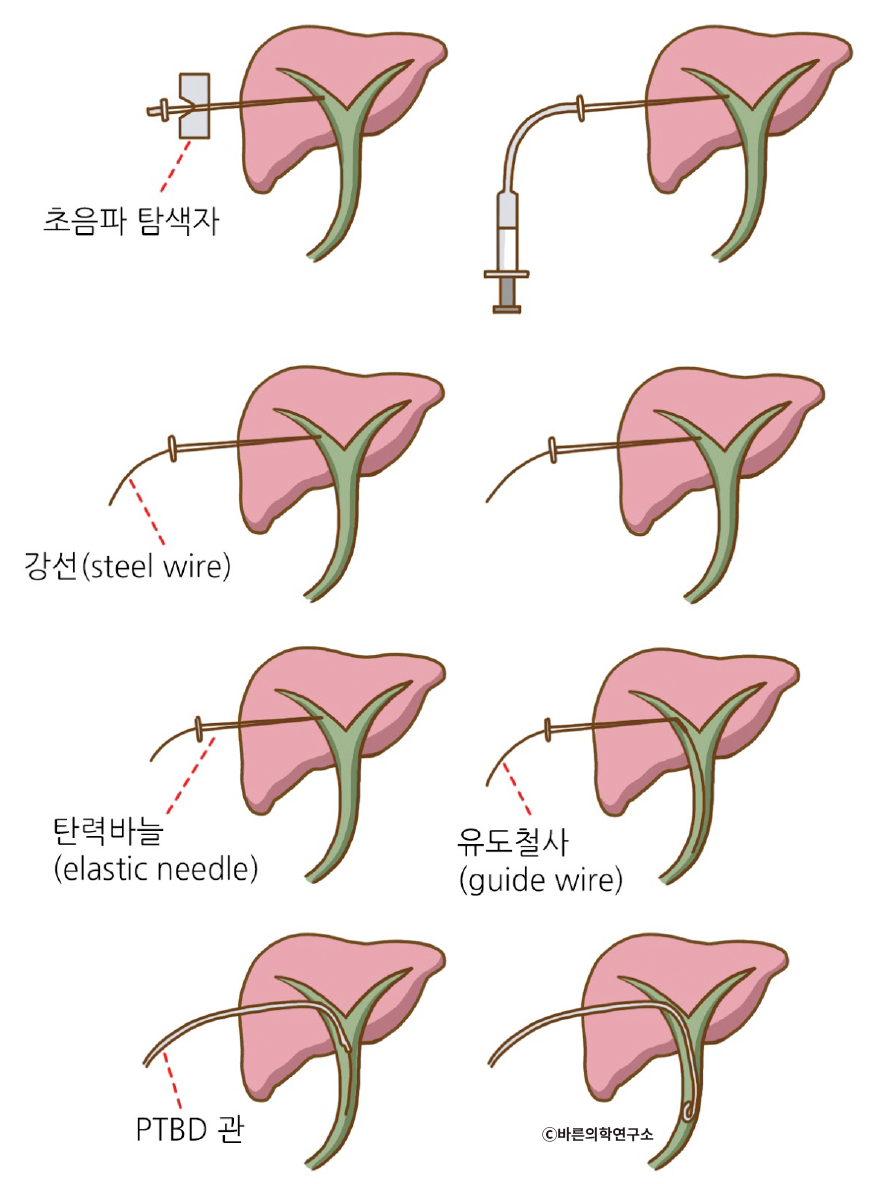 담관염(Cholangitis): 치료 - Metamedic
