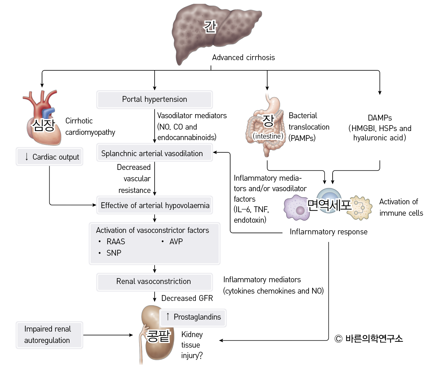 간경변증 합병증: 급성신손상/간신증후군 - Metamedic