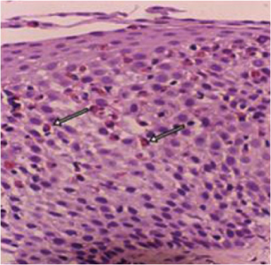 식도질환: 호산구식도염(Eosinophilic Esophagitis, EoE) - Metamedic