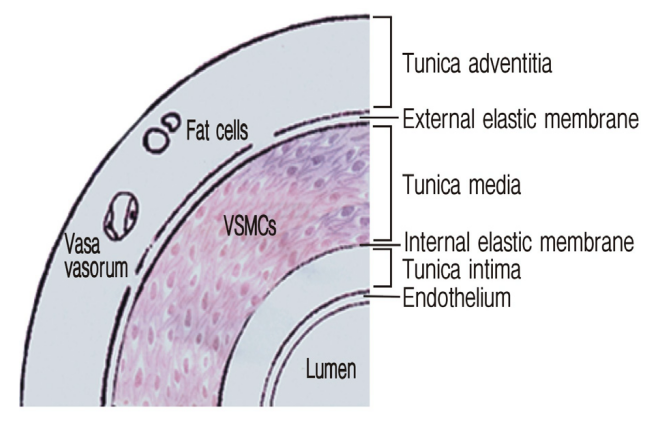 죽상경화증(Atherosclerosis) - Metamedic