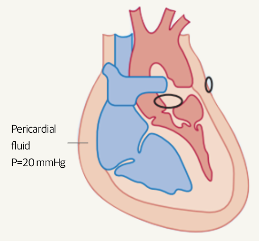 심낭압전/심장눌림증(cardiac tamponade) - Metamedic