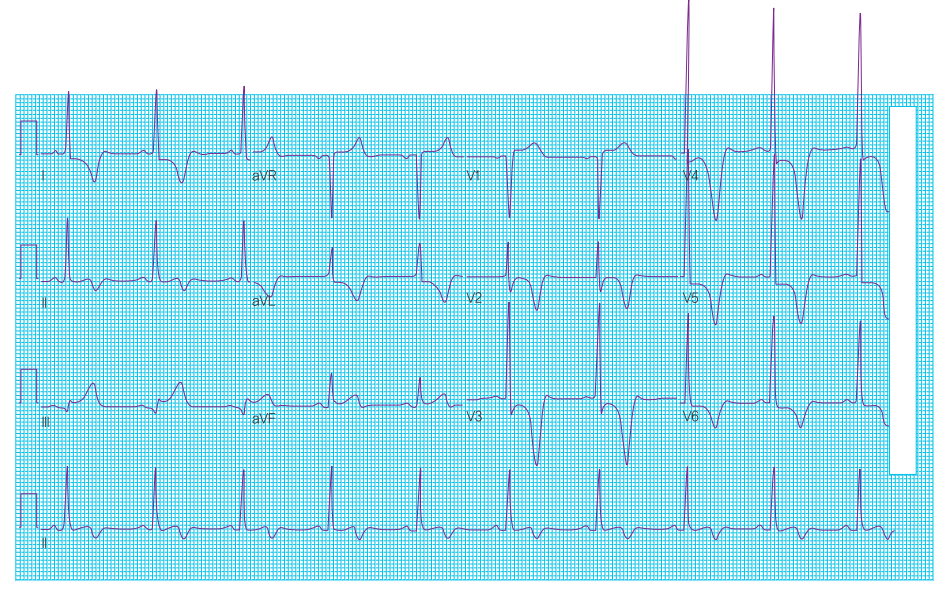 비대심근병증(Hypertrophic cardiomyopathy, HCM) - Metamedic