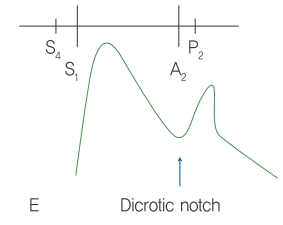 확장 심근병증(Dilated cardiomyopathy, DCM) - Metamedic