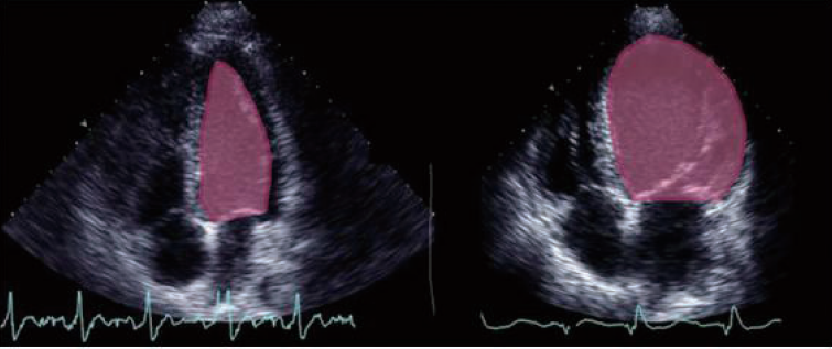 확장 심근병증(Dilated cardiomyopathy, DCM) - Metamedic