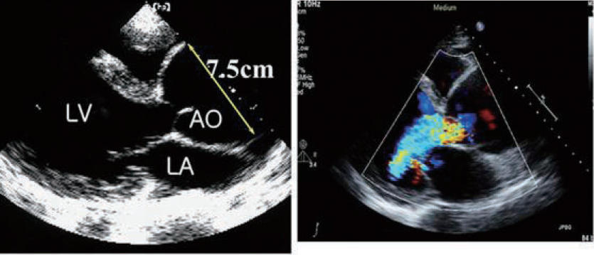 대동맥판역류증(Aortic regurgitation, AR) - Metamedic