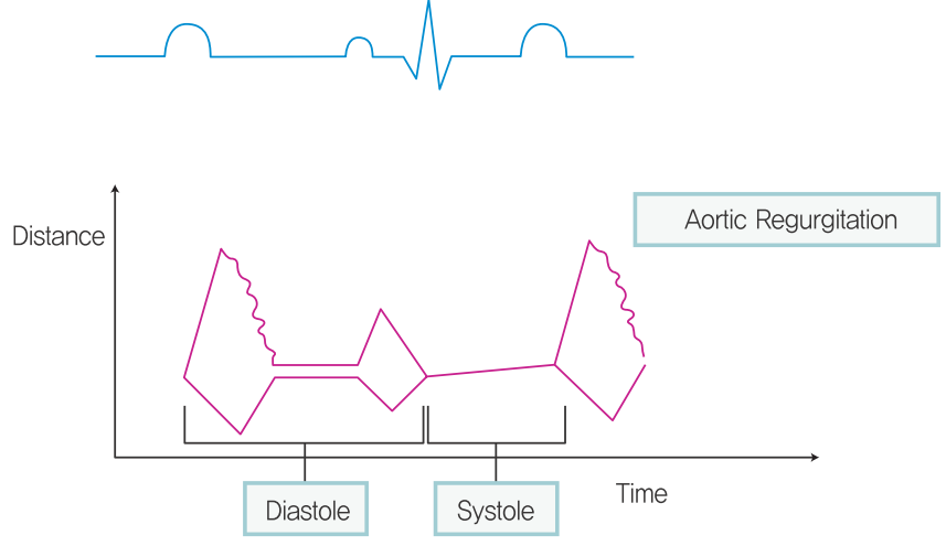 대동맥판역류증(Aortic regurgitation, AR) - Metamedic