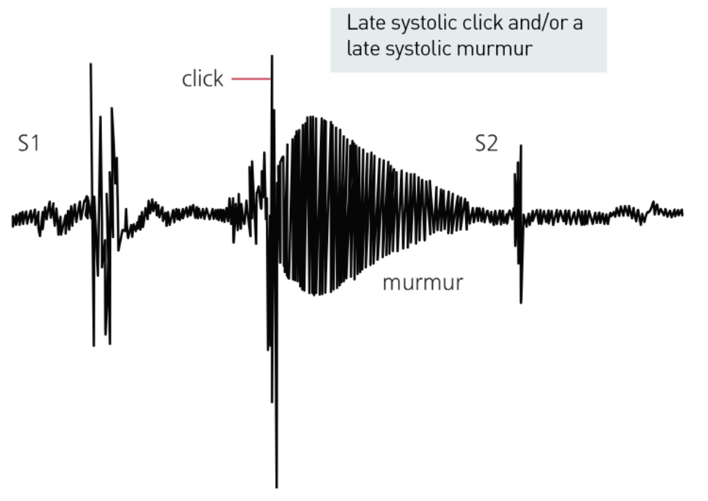 승모판 탈출증(Mitral valve prolapse, MVP) - Metamedic