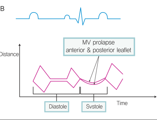 승모판 탈출증(Mitral valve prolapse, MVP) - Metamedic