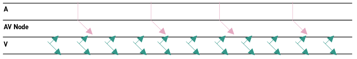 심실빈맥(VT) - Metamedic