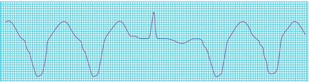 심실빈맥(VT) - Metamedic
