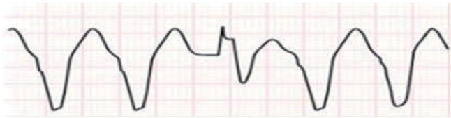 심실빈맥(VT) - Metamedic