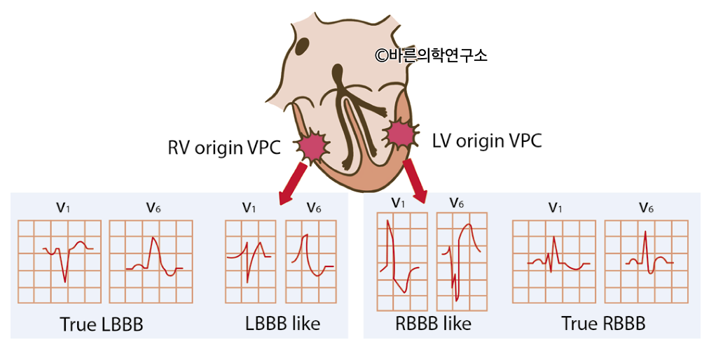 심실빈맥(VT) - Metamedic