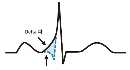 PSVT/WPW syndrome - 조기흥분증후군(Preexcitation syndrome, WPW syndrome ...