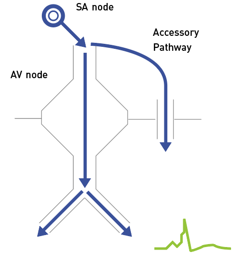 PSVT/WPW syndrome - 방실 회귀 빈맥 (AV Reentrant Tachycardia, AVRT) - Metamedic