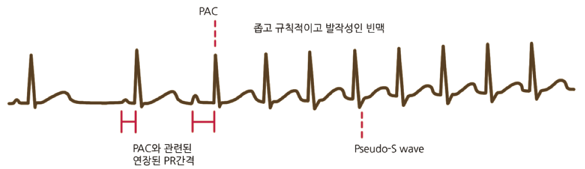 PSVT/WPW syndrome - 방실결절 회귀 빈맥 (AV nodal Reentrant Tachycardia, AVNRT ...
