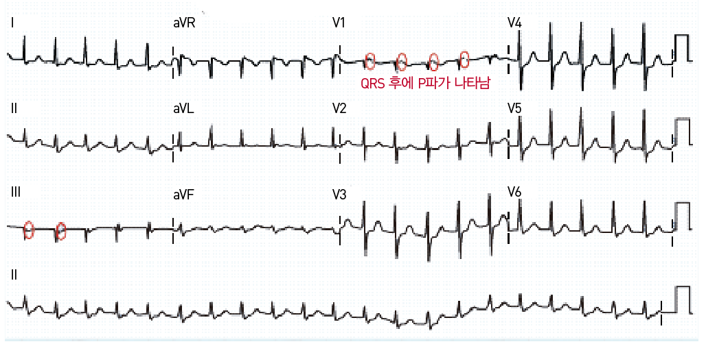 PSVT/WPW syndrome - 방실결절 회귀 빈맥 (AV nodal Reentrant Tachycardia, AVNRT ...