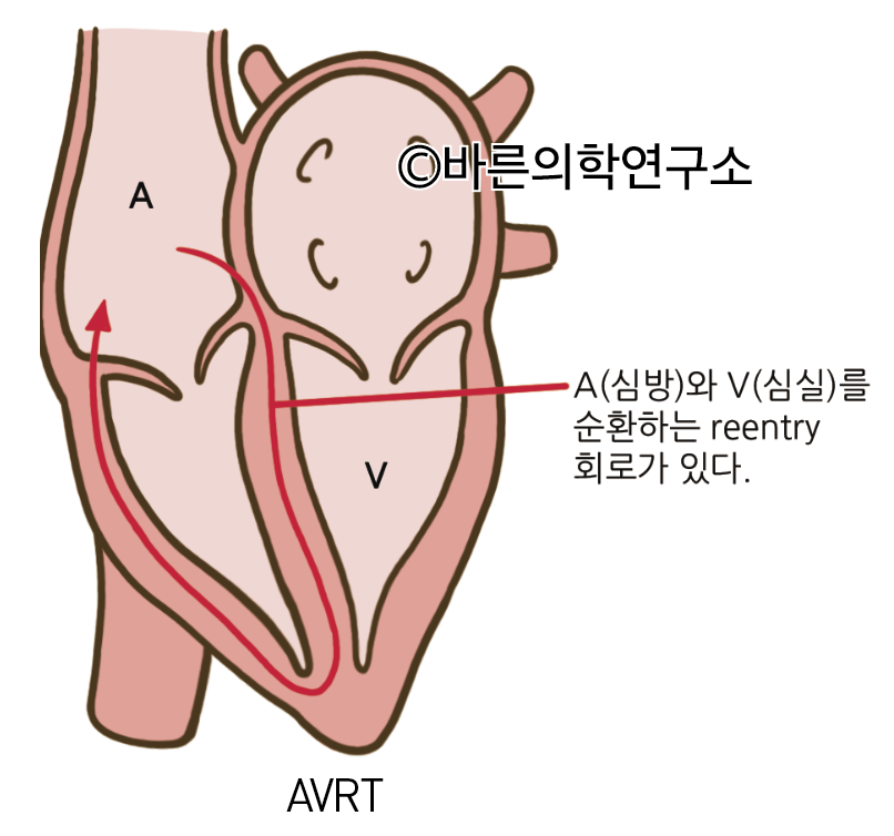 PSVT/WPW syndrome: 개요 - Metamedic