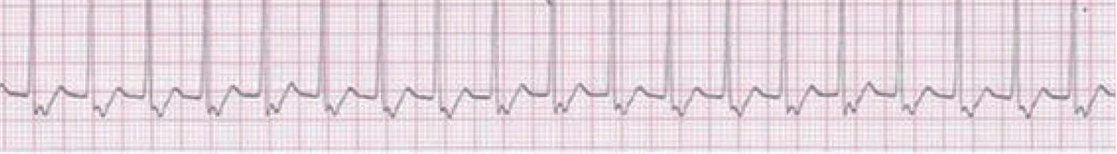PSVT/WPW syndrome: 개요 - Metamedic