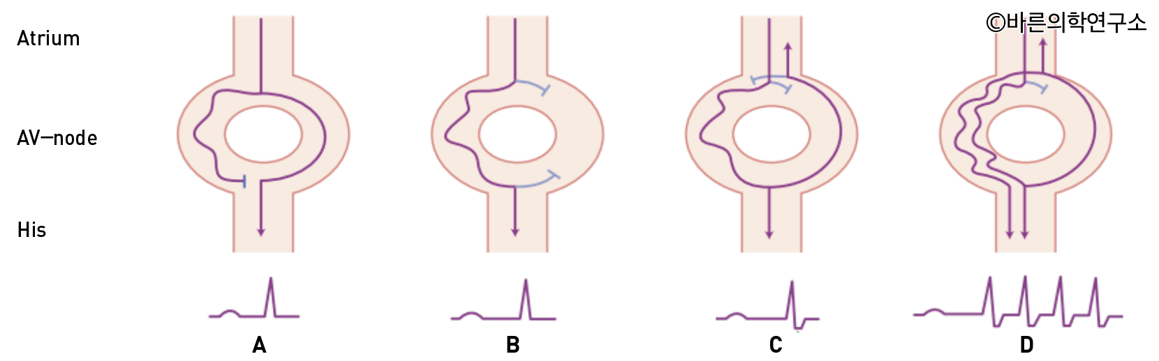 PSVT/WPW syndrome: 개요 - Metamedic
