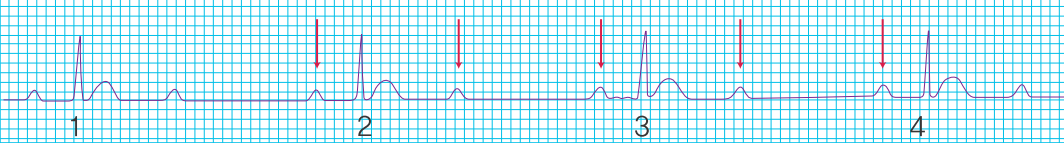 서맥부정맥: 방실결절전도장애(AV conduction disease, AV block) - Metamedic