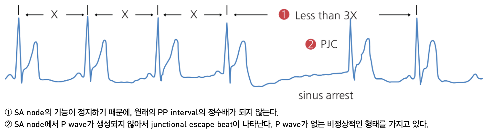 서맥부정맥: 동기능 부전(SA node dysfunction) - Metamedic