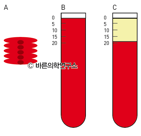파종혈관내응고 (Disseminated Intravascular Coagulation, DIC): 진단 및 치료 - Metamedic