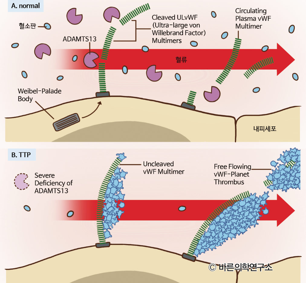 혈전혈소판감소자색반병(thrombotic thrombocytopenia purpura, TTP) - Metamedic