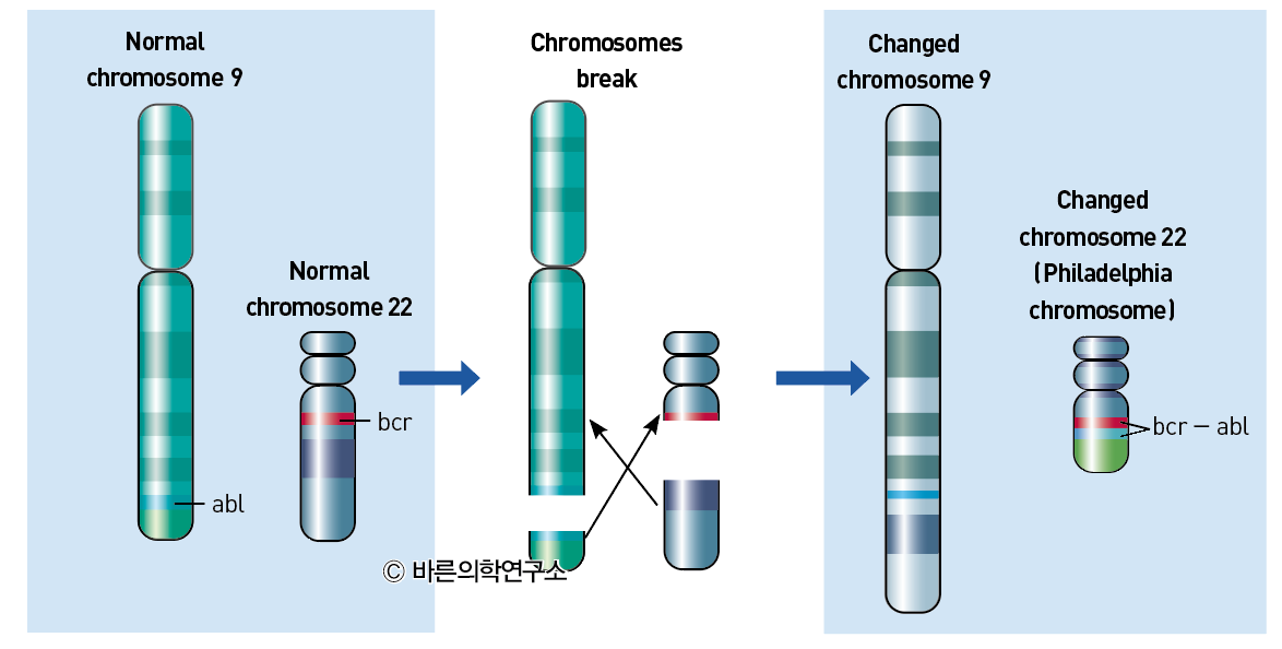 만성 골수성 백혈병 Chronic Myelogenous Leukemia Cml Metamedic