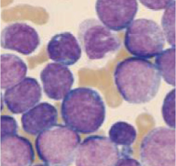급성골수성백혈병(Acute myeloid leukemia, AML) - Metamedic