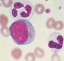 급성골수성백혈병(Acute myeloid leukemia, AML) - Metamedic