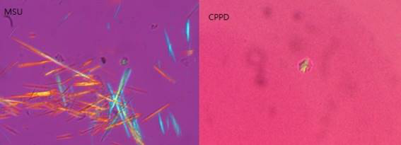 가성통풍: CPPD(Calcium Pyrophosphate Deposition) disease - Metamedic