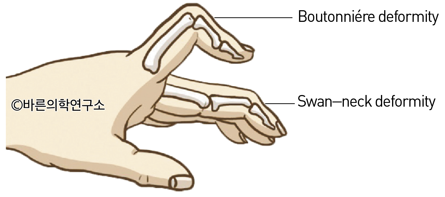 류마티스 관절염(Rheumatoid arthritis, RA): 진단 - Metamedic