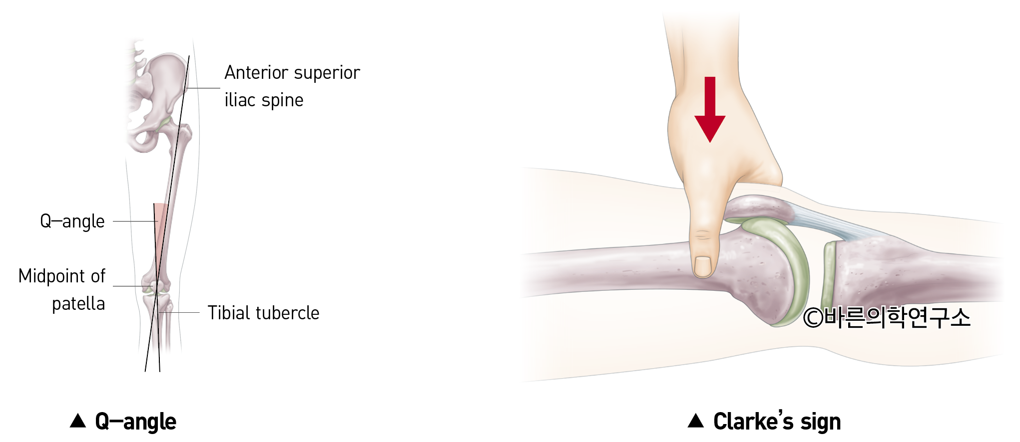 슬개골 병변 - Metamedic