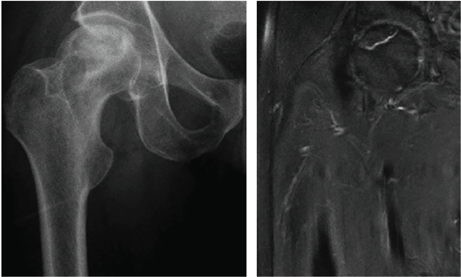 대퇴골두 골 괴사증(Osteonecrosis of the Femoral Head, ONFH) - Metamedic