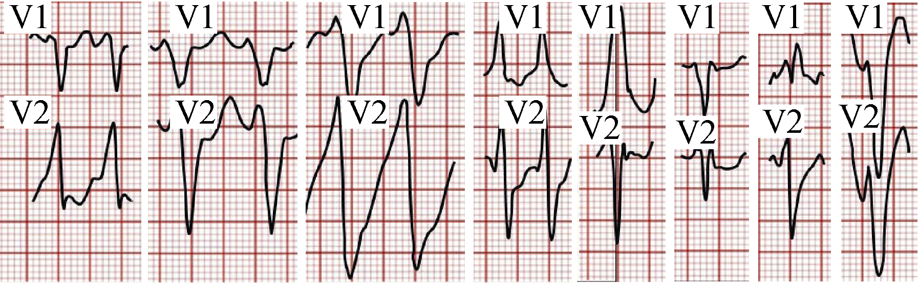 빈맥(Tachycardia)의 접근: 넓은 QRS 빈맥(Wide QRS Tachycardia) - Metamedic