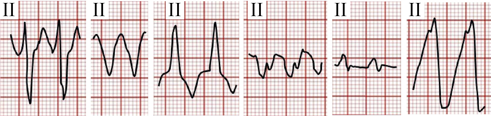 빈맥(Tachycardia)의 접근: 넓은 QRS 빈맥(Wide QRS Tachycardia) - Metamedic